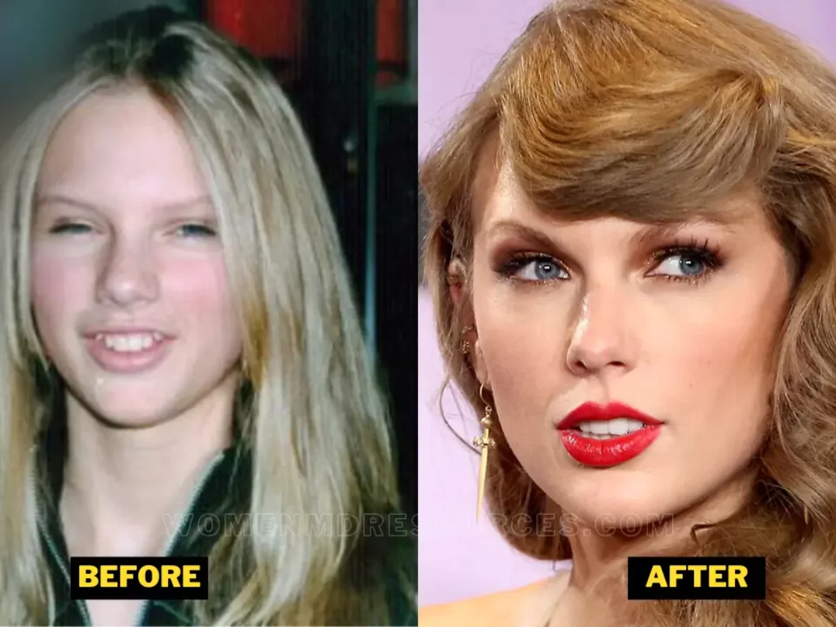 Taylor Swift Before And After Veneers